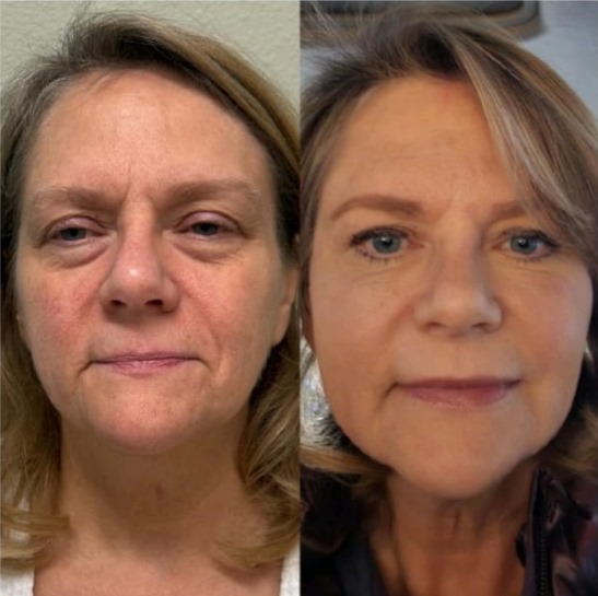 Jett Plasma - Karl-Müeller Scientific